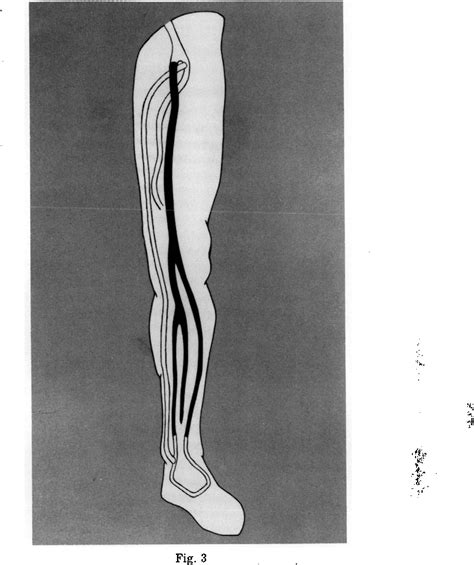 Figure 3 From Femoro Distal Posterior Tibial Bypass Management Of