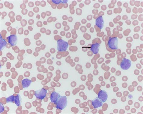 Monoblastic Leukemia