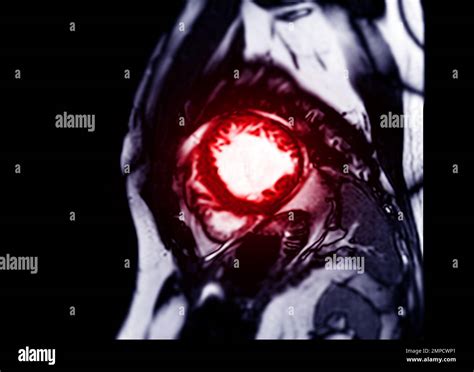 Mri Heart Or Cardiac Mri In Short Axis View Showing Cross Sections Of