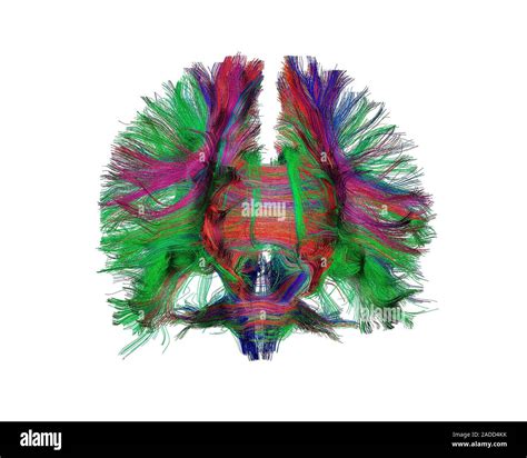 Diffusion Tensor Imaging Dti Scan Reconstructed Brain White Matter Fibres Of The Whole Brain