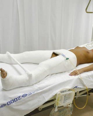 Gips Cast Porn Pictures XXX Photos Sex Images 1285921 PICTOA