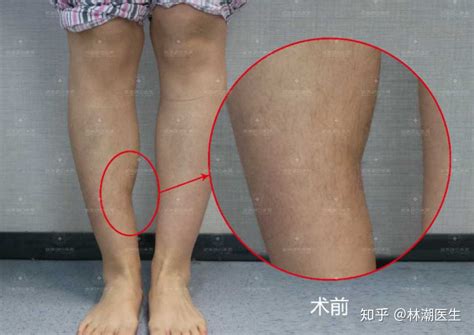 小腿凹进去一块图片小腿前面凹陷图片 伤感说说吧