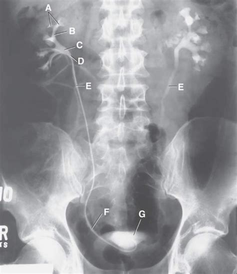 Retrograde Pyelogram Diagram Quizlet