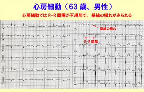 1心房細動の心電図 ｜ 心房細動について ｜ 心臓・血管の話 みやけ内科・循環器科