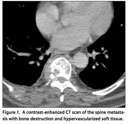 Endovascular Today Preoperative Embolization Of Thoracic Spine
