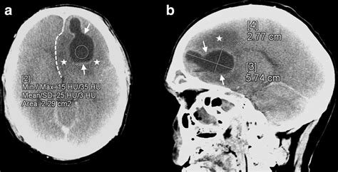 axial 1a and sagittal 1b pmct image of the skull demonstrating a