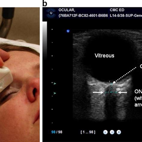 Ocular Ultrasonography 4a Shows Probe Positioning Over A Closed Download Scientific Diagram