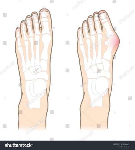 Skeletal Illustration Normal Foot Hallux Valgus Stock Vector Royalty