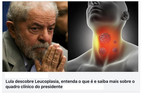 Lula Da Silva Foi Submetido A Uma Laringoscopia Para Remover