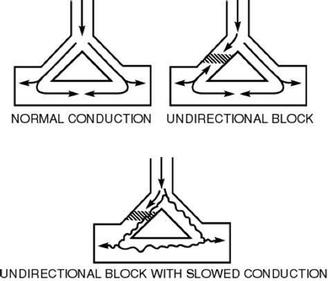 Arrhythmia Anesthesia Key