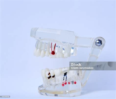 치과 의사 치아 플라스틱 모델 교수에 대 한 나사 임 플 란 트 학습 및 치아와 잇 몸을 보여주는 치과 사무실에서 환자 0명에 대한 스톡 사진 및 기타 이미지 Istock