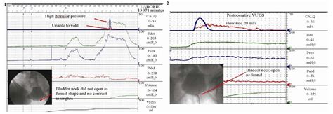 Video Urodynamics Study On Female Patients With Bladder Neck Chinese Medical Journal