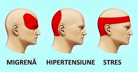Durerea de cap cauze simptome clasificare și remedii