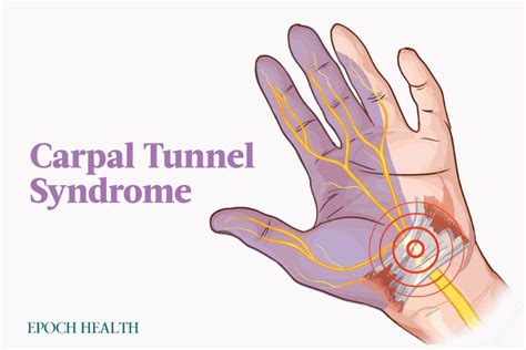 Carpal Tunnel Syndrome The Epoch Times