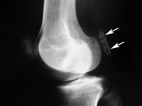 Symptomatic Enlarged Fabella Bmj Case Reports