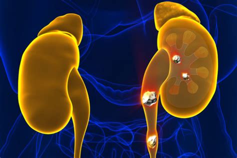 Nephrolithiasis Suffolk Nephrology Associates