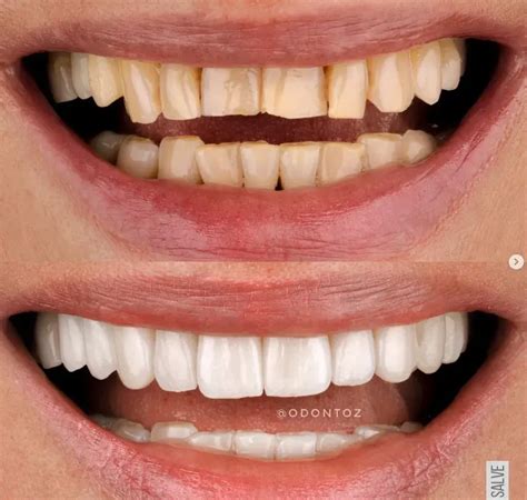 O Que é Abscesso Dentário E Como Tratar Odontoz