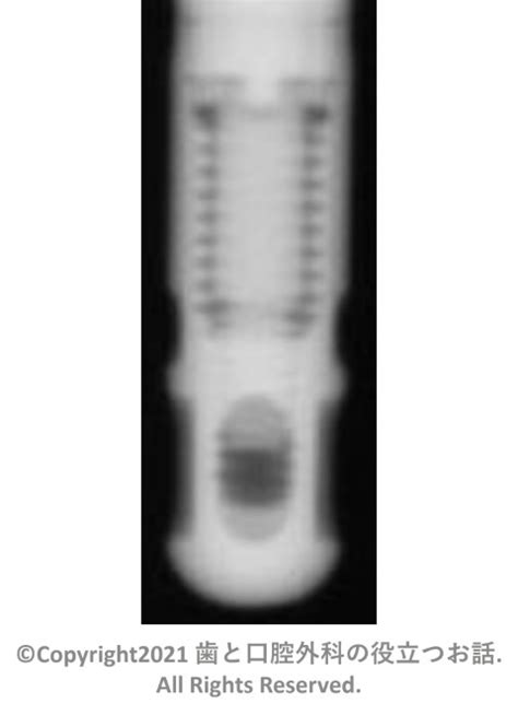 Imz Implant Twinplus Cylinder Type 歯と口腔外科の役立つお話