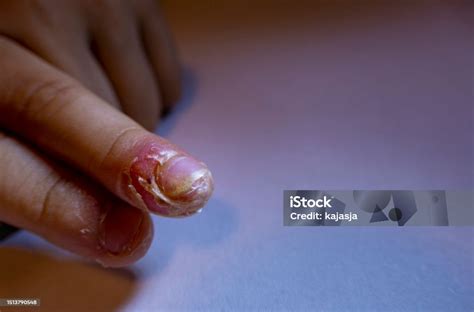 손톱 찢어짐 감염으로 인한 염증으로 손가락이 부어 오름 건강 진단에 대한 스톡 사진 및 기타 이미지 건강 진단 건강관리와 의술 건강한 생활방식 Istock