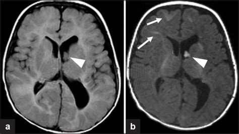 Clinically Relevant Imaging In Tuberous Sclerosis Journal Of Clinical
