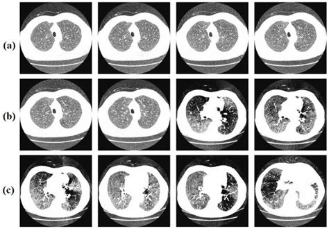 Dung Beetle Optimization With Deep Feature Fusion Model For Lung Cancer Detection And Classification