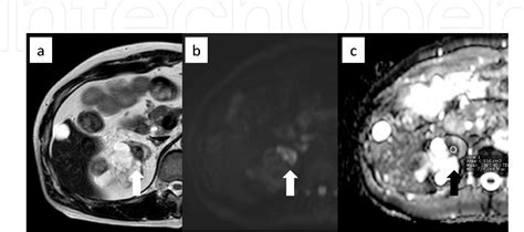 Figure 1 From Renal Cell Carcinoma In End Stage Renal Disease