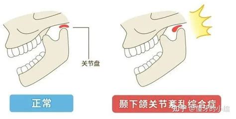 热知识单侧咀嚼好不好？ 知乎
