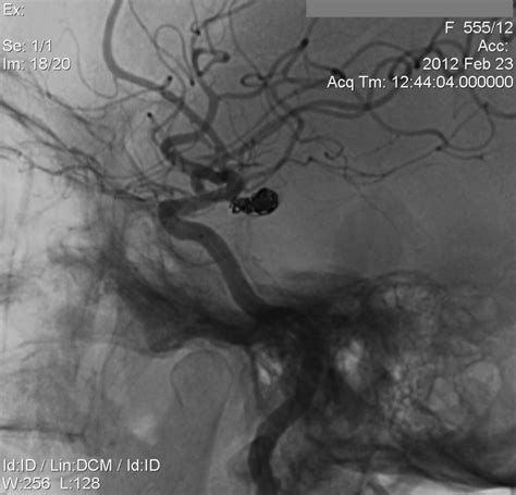 Ica Supraclinoid Segment Mirror Aneurysms Case Report And Review Of