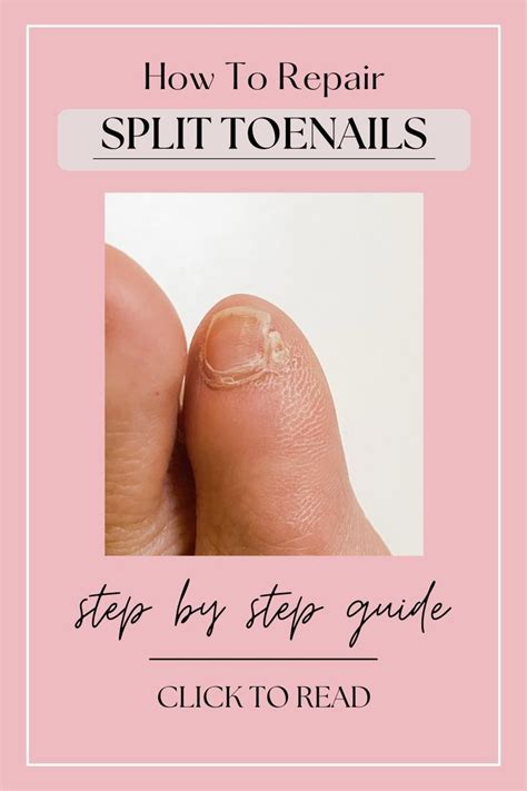 Step By Step Guide To Fix Embarrassing Split Pinky Toenails