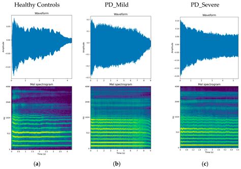 Leveraging Deep Learning For Fine Grained Categorization Of Parkinsons Disease Progression