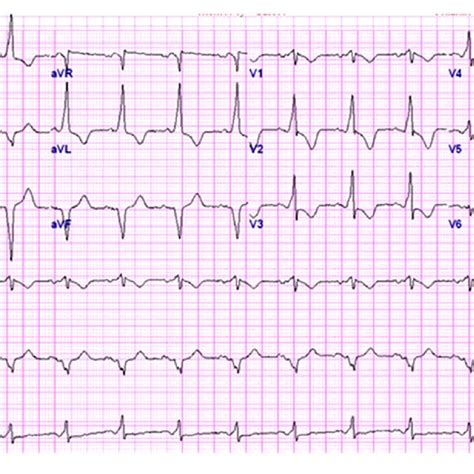 Pdf When A Pseudo Infarct Electrocardiogram Ecg Pattern In A Posterior Accessory Wolff