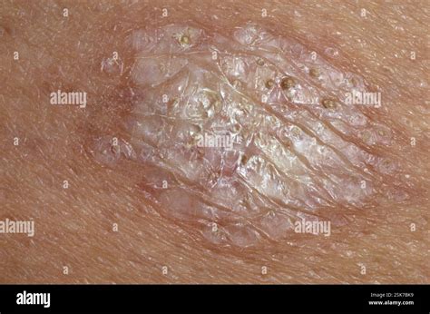 Lichen Sclerosus Close Up Of A Lesion On The Skin Of A 44 Old Year
