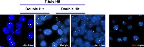 Interphase Fish Showing Rearrangements Of Myc Bcl2 And Bcl6 Genes