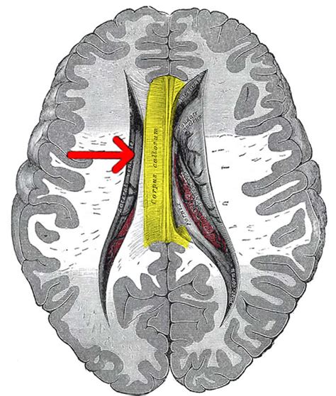 crosstalk between left and right hemisphere is key to language