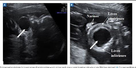 Figure 1 From [congenital Mucocele Of The Ventral Face Of The Tongue] Semantic Scholar