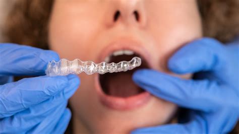 Invisalign Clear Aligners Straighten Your Teeth Discreetly