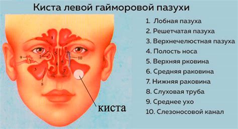 Почему развивается и чем опасна киста гайморовой пазухи