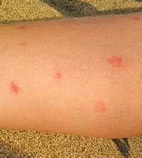 Identifying What Bug Bit You By Your Symptoms