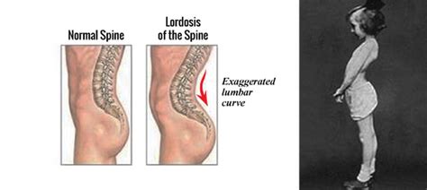 Swayback Lordosis