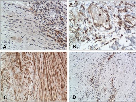 Expression Of Mmps And Timps In Aaa Samples A Immunostaining Of Mmp 2