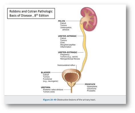 Iii Lower Urinary Tract And Male Genital System Nus Pathweb Nus Pathweb