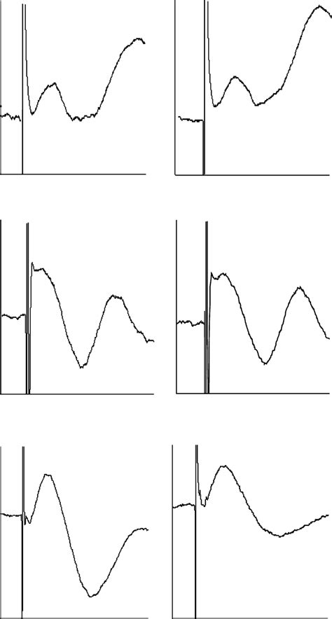 Representative Individual Examples Of Local Field Potential Responses