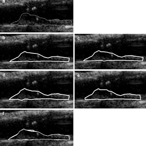 Pdf Atherosclerotic Carotid Plaque Segmentation In Ultrasound Imaging Of The Carotid Artery