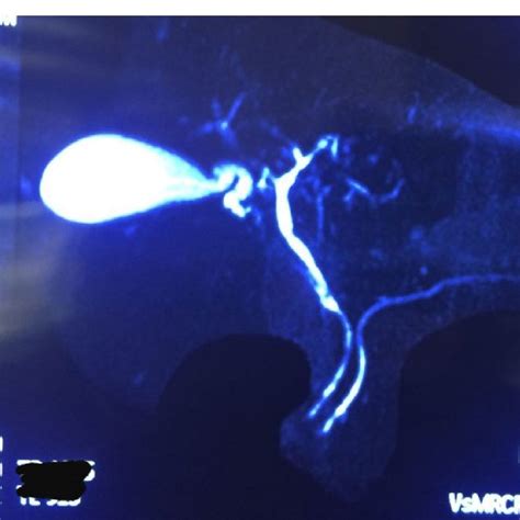 Second MRCP Of The Patient After Months Download Scientific Diagram