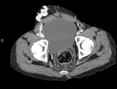 Computed Tomography Scan Of The Abdomen And Pelvis With Contrast Axial
