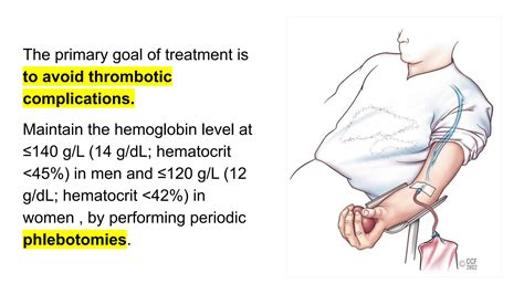 Polycythemia Vera Based On Harrisons Principles Of Internal Medicine
