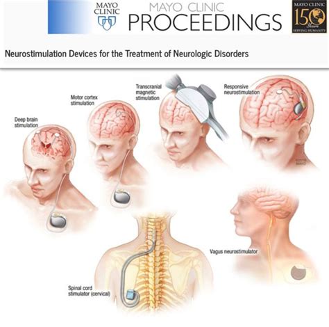 Neuromodulation Devices For The Treatment Of Neurologic Medizzy