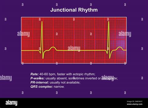 Illustration Of An Electrocardiogram Ecg Displaying A Junctional