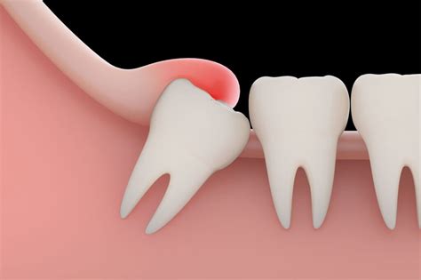 Wisdom Teeth Mint Dental Gold Coast