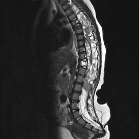 Intraspinal Extradural Mass Lesion Extending From The Thoracal 4 Level